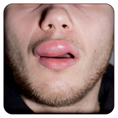Treatment of Allergic and Nonallergic Angioedema